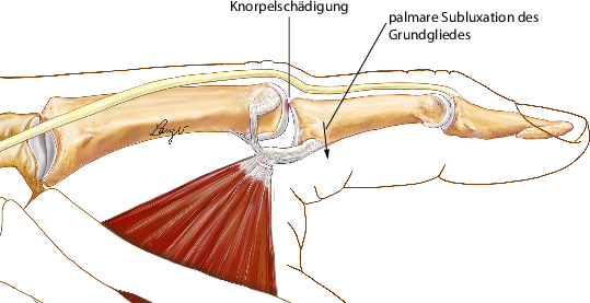 Ulnare Kollateralbandplastik des Daumengrundgelenks bei chronischer ...