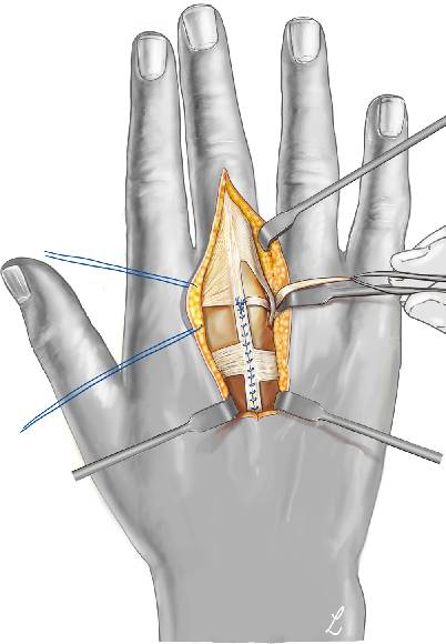 Bandplastik bei Strecksehnenluxation über dem Fingergrundgelenk ...