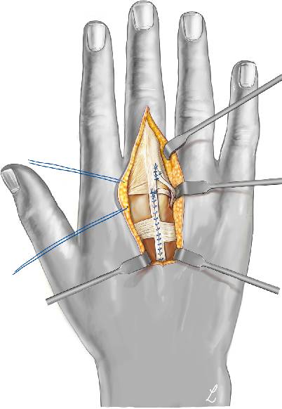 Bandplastik bei Strecksehnenluxation über dem Fingergrundgelenk ...