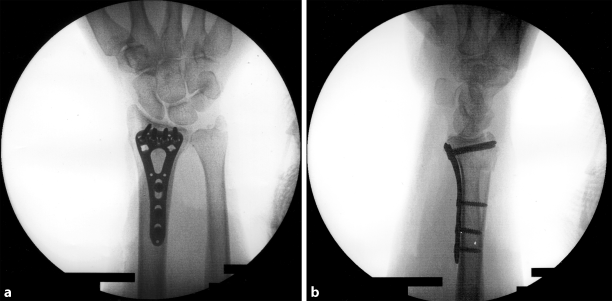 Die palmare winkelstabile Plattenosteosynthese bei Extensionsfrakturen ...