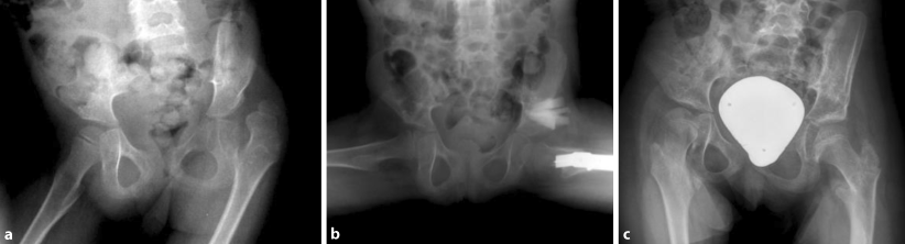 Technik der modifizierten PemberSal-Osteotomie mit lyophilisiertem ...