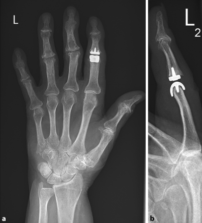 Oberflächenersatz am Fingermittelgelenk mittels CapFlex-PIP | SpringerLink