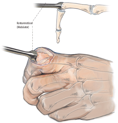 Oberflächenersatz am Fingermittelgelenk mittels CapFlex-PIP | SpringerLink
