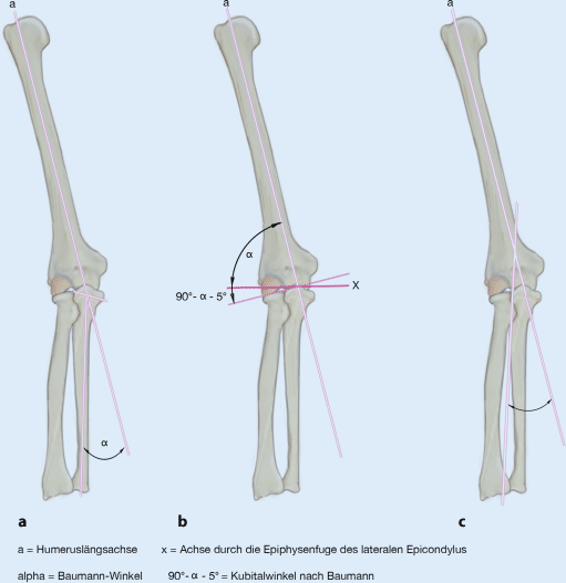 Korrekturosteotomien bei posttraumatischen Fehlstellungen des ...