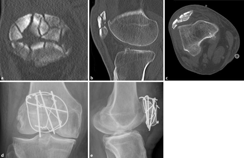 Plattenosteosynthese bei Patellafrakturen | SpringerLink