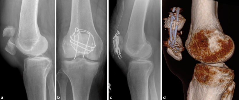 Plattenosteosynthese bei Patellafrakturen | SpringerLink