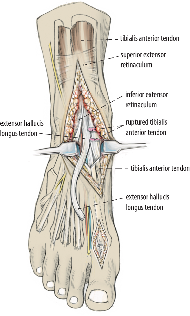 Extensor hallucis longus-transfer for tibialis anterior tendon rupture ...