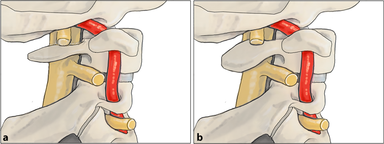 Dorsale Stabilisation der Halswirbelkörper HWK1/HWK2 modifiziert nach ...