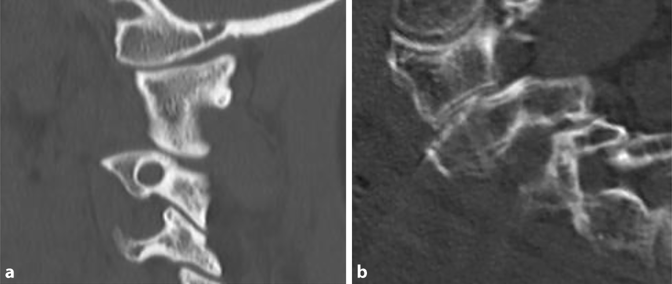 Dorsale Stabilisation der Halswirbelkörper HWK1/HWK2 modifiziert nach Goel-Harms mit HWK-1 ...