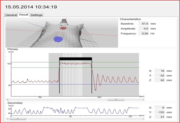 Deep inspiration breath-hold (DIBH) radiotherapy in left-sided breast ...