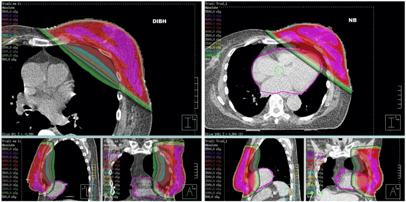 Deep inspiration breath-hold (DIBH) radiotherapy in left-sided breast ...