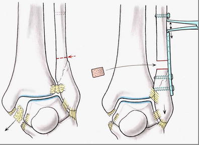 Treatment of malunion in ankle fractures | SpringerLink