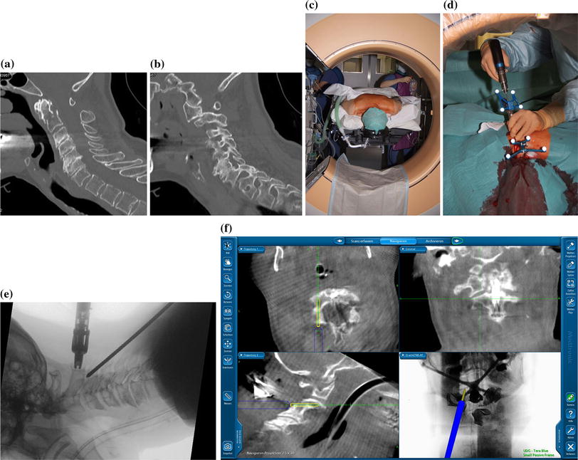 O-arm®-based spinal navigation and intraoperative 3D-imaging: first ...
