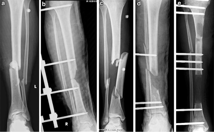 Ganga hospital open injury score in management of open injuries ...