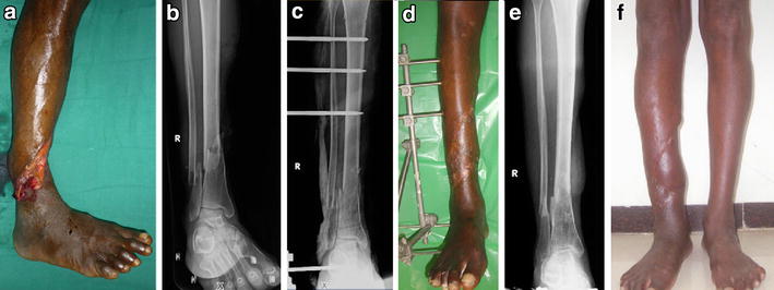 Ganga hospital open injury score in management of open injuries ...