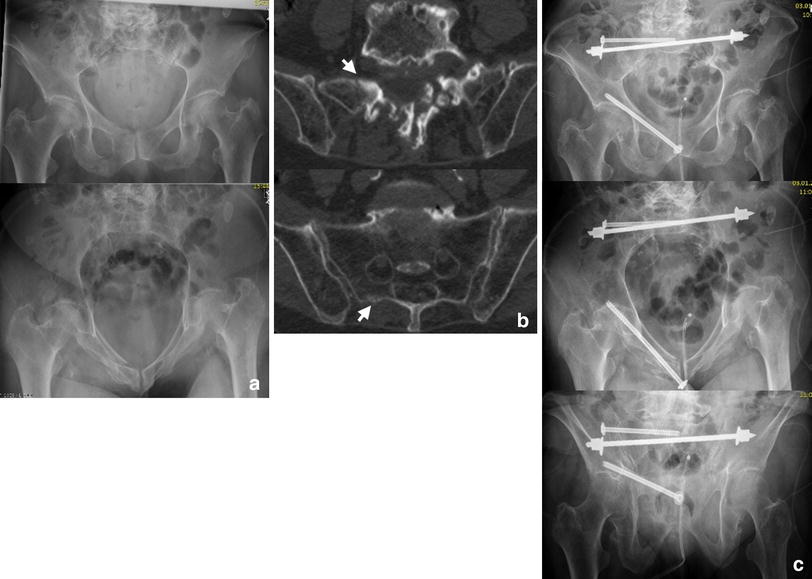 Fragility fractures of the sacrum: how to identify and when to treat ...