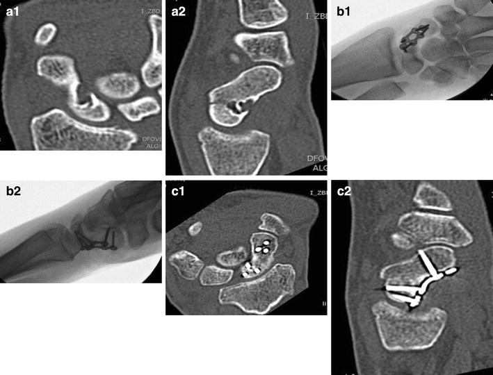 Current concepts for the treatment of acute scaphoid fractures ...