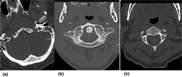 It is the lateral head tilt, not head rotation, causing an asymmetry of ...