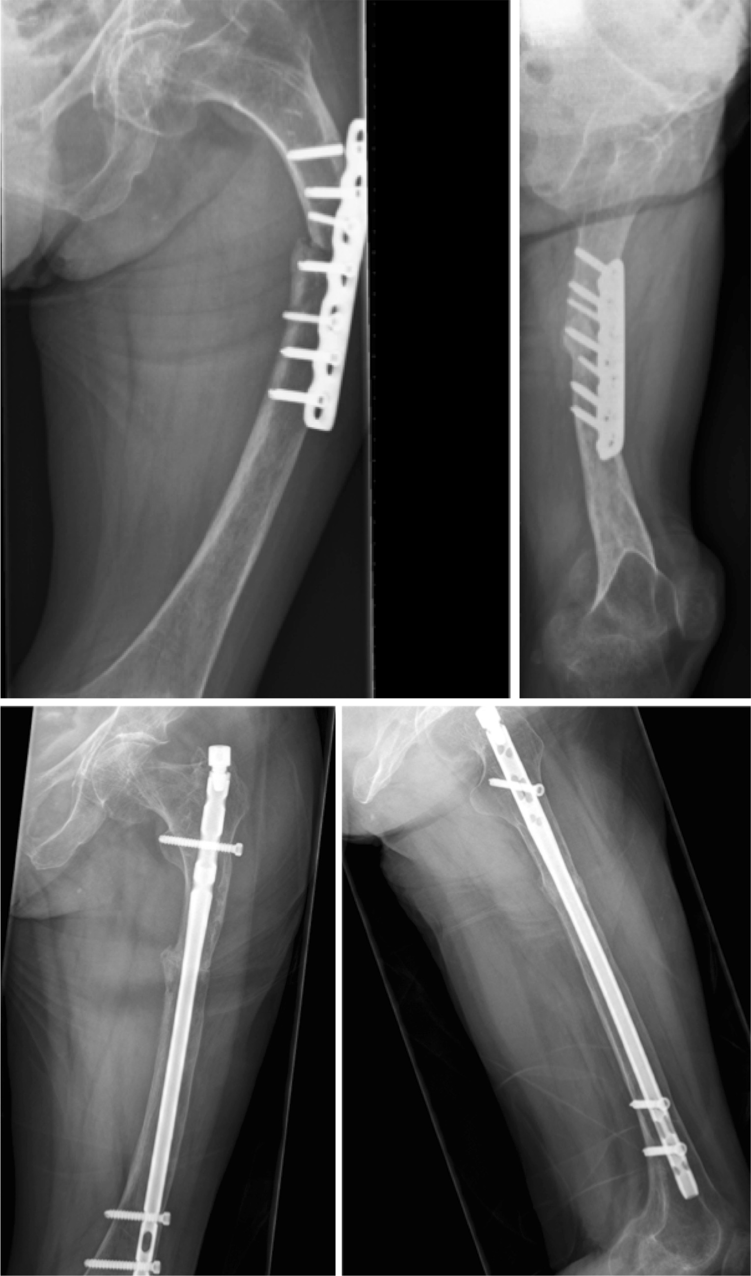Incidence and treatment of femur fractures in adults with osteogenesis ...