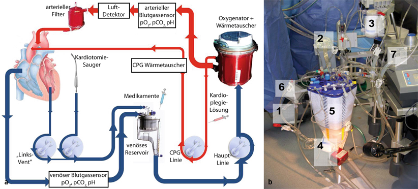 Kardiopulmonaler Bypass in der Herzchirurgie | SpringerLink