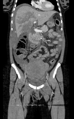 Versorgung einer schwangeren Patientin nach Polytrauma | SpringerLink