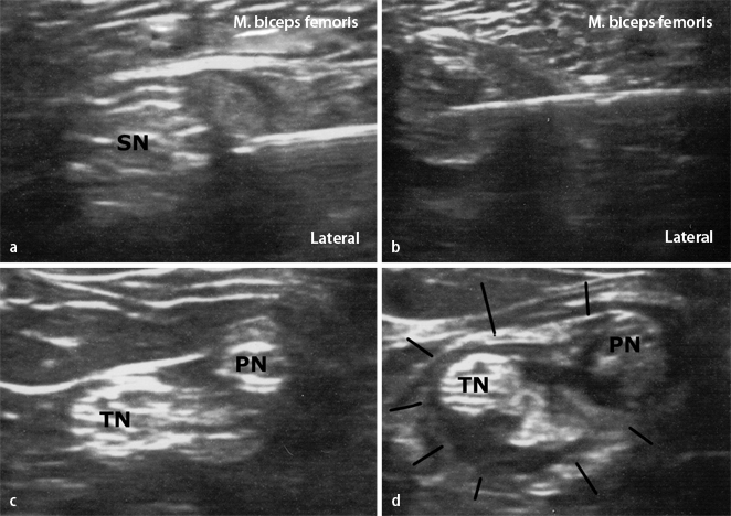Distale Blockaden des N. ischiadicus | SpringerLink