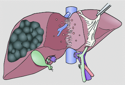 Technik der Leberresektion | SpringerLink