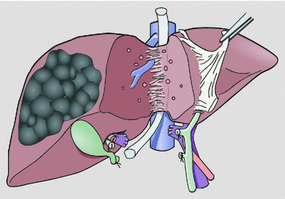 Technik der Leberresektion | SpringerLink
