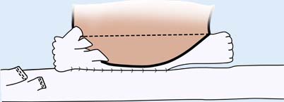 Orthotope Lebertransplantation | SpringerLink