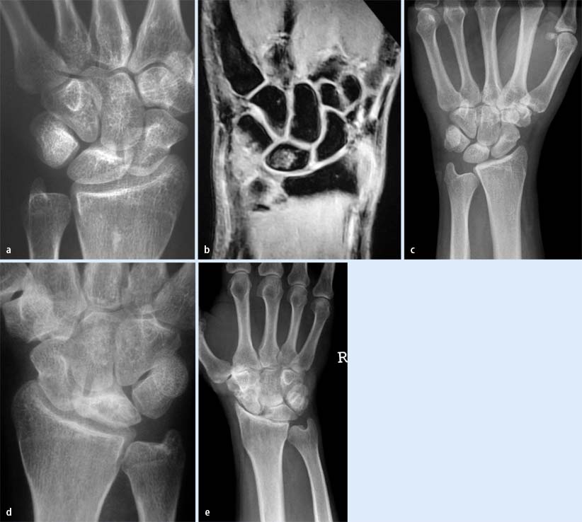 Morbus Kienböck | SpringerLink