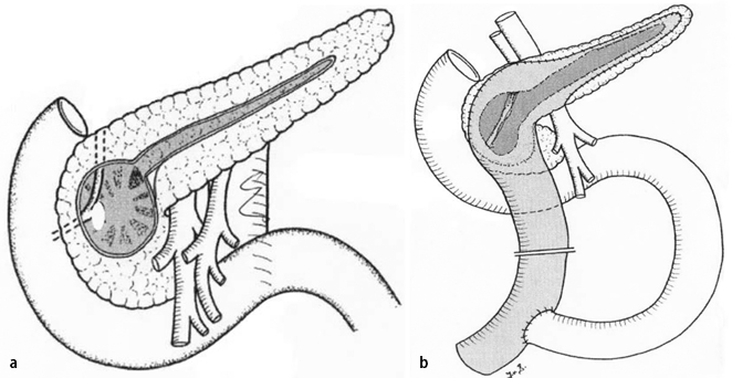 Duodenumerhaltende Pankreaskopfresektion | SpringerLink
