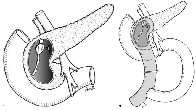 Duodenumerhaltende Pankreaskopfresektion | SpringerLink