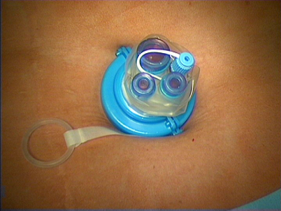 Single-port-Technik in der laparoskopischen Chirurgie | SpringerLink