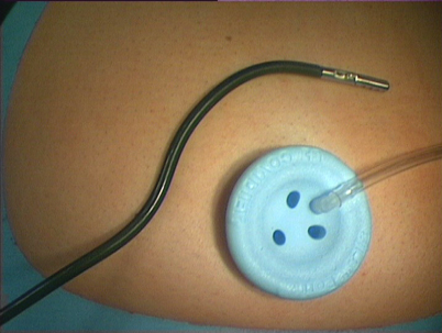 Single-port-Technik in der laparoskopischen Chirurgie | SpringerLink