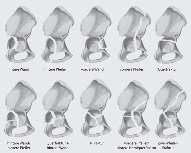 Azetabulumfrakturen | SpringerLink