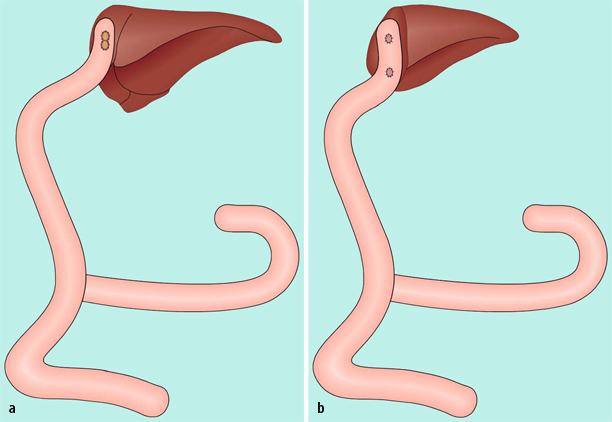 Biliodigestive Anastomosen | SpringerLink