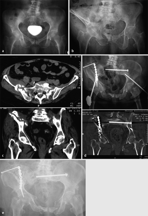 Aktuelle Behandlung der Beckenringfraktur | SpringerLink