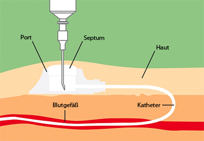 Indikation, Technik und Komplikationen der Portimplantation | SpringerLink