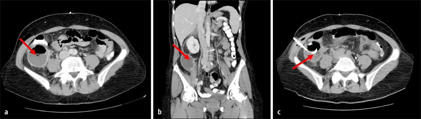 Moderne Therapie perityphlitischer Abszesse | SpringerLink
