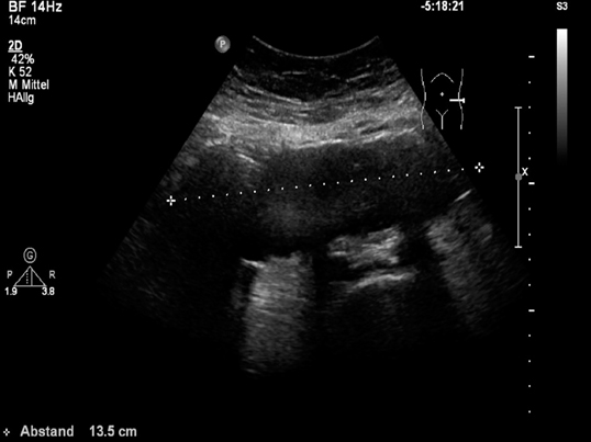 Großer zystischer Tumor im rechten Unterbauch | SpringerLink