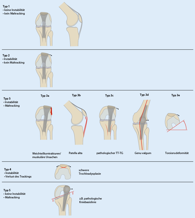 Patellaluxation bei Sportlern | SpringerLink