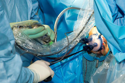 Hybrid-TAMIS totale mesorektale Exzision | SpringerLink