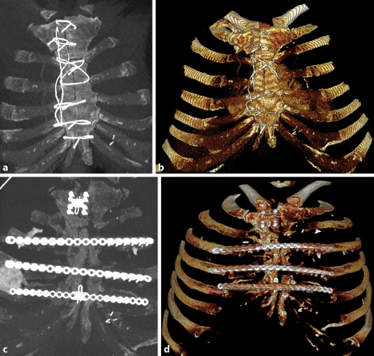Plastische Rekonstruktionsverfahren der Brustwand nach Mediastinitis ...