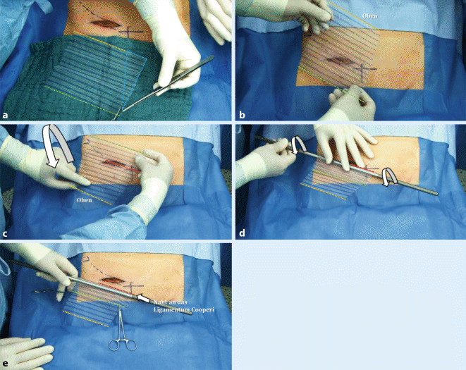 Leisten- und Schenkelhernienchirurgie | SpringerLink