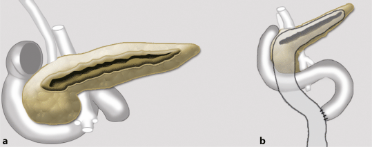 Pankreasanastomosen bei operativer Versorgung der chronischen ...