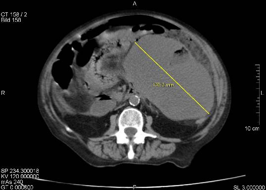 Eine seltene Ursache der Dünndarmperforation | SpringerLink