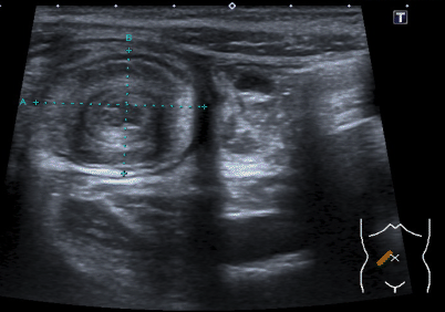 Kokarden des Zökums bei einem Kind mit akuten Bauchschmerzen | SpringerLink