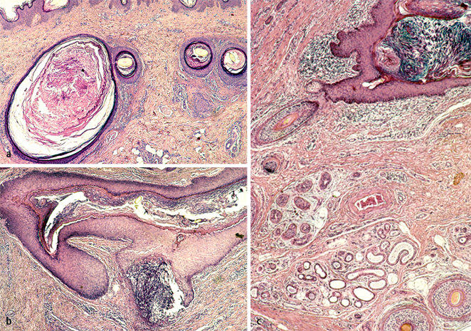 Acne inversa | SpringerLink