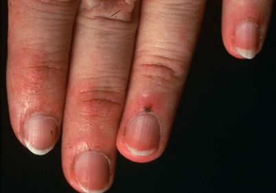 Update: Dermatomyositis | SpringerLink