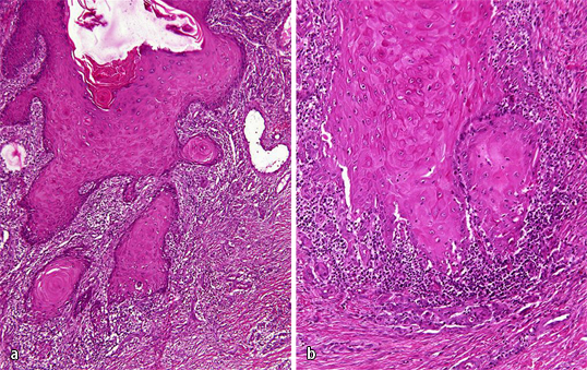 Verruköses spinozelluläres Karzinom auf Lichen ruber hypertrophicus ...